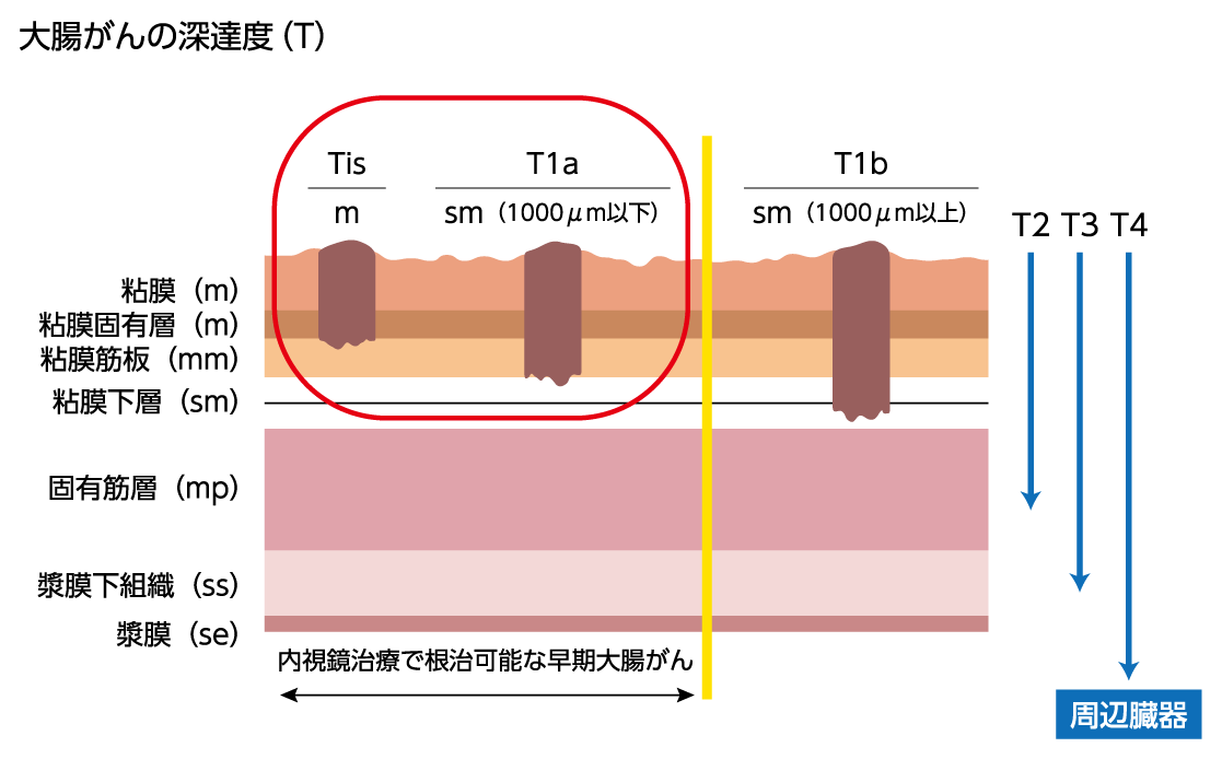 大腸がんの治療・大腸ESDってどんな治療なの？ | 東京千住・胃と大腸の消化器内視鏡クリニック 足立区院